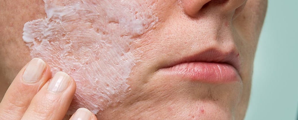 Krem na nużeńca - jak wybrać? Krem demodex - Nużyca - objawy, przyczyny ...